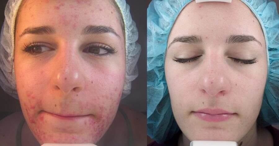 Chemical Peel Cincinnati - VI Peel - Glycolic Acid Peels