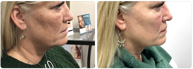 Face Lift Without Surgery in Cincinnati, Ohio | Ultherapy