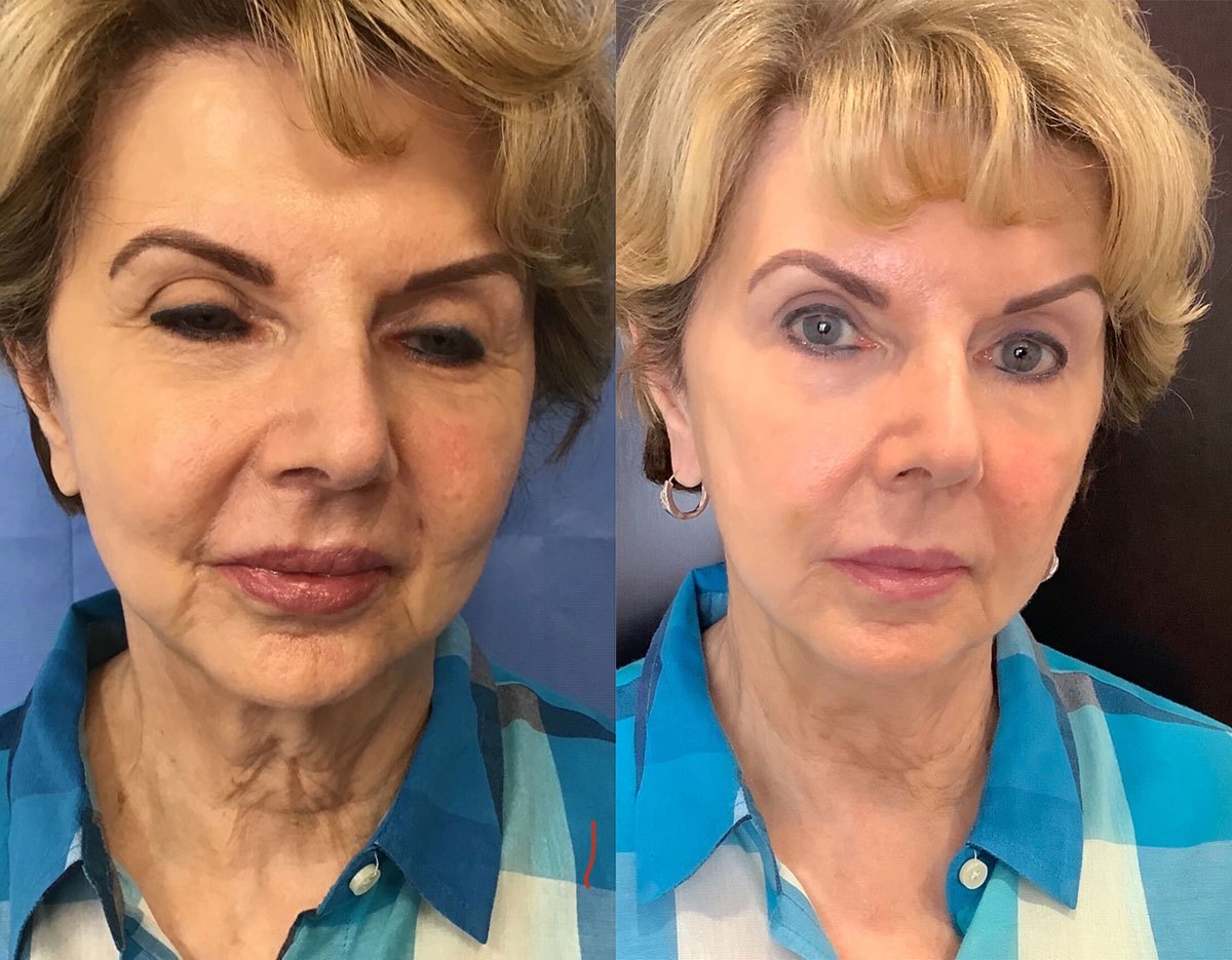 Face Lift Without Surgery in Cincinnati, Ohio | Ultherapy