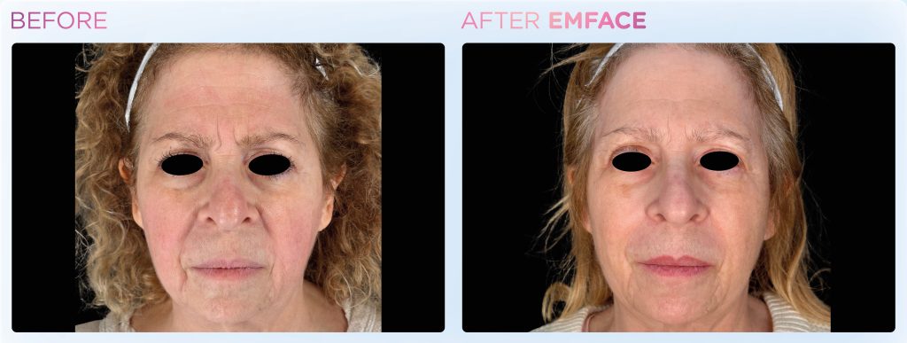 EMFACE - Less Wrinkles, More Lift in Cincinnati Ohio
