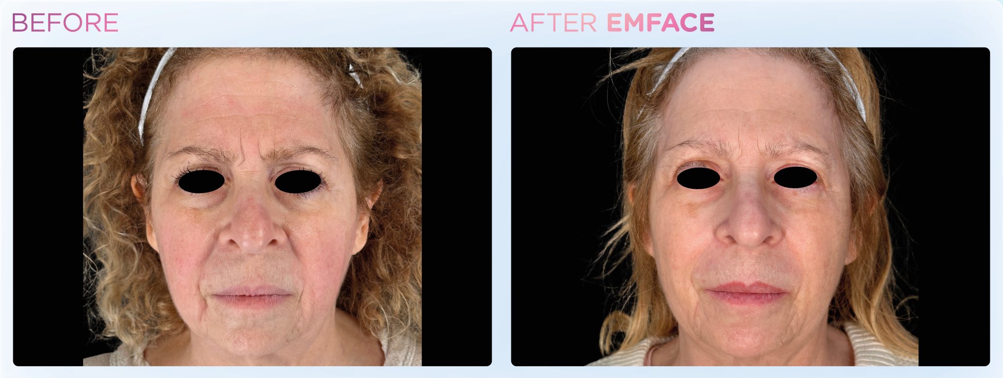 EMFACE - Less Wrinkles, More Lift in Cincinnati Ohio