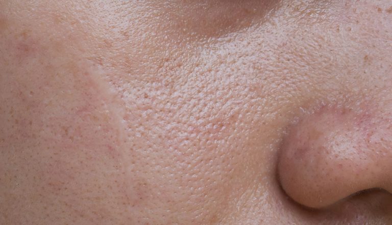 Can Laser Treatment Fix Large Pores? | Cincinnati, Ohio